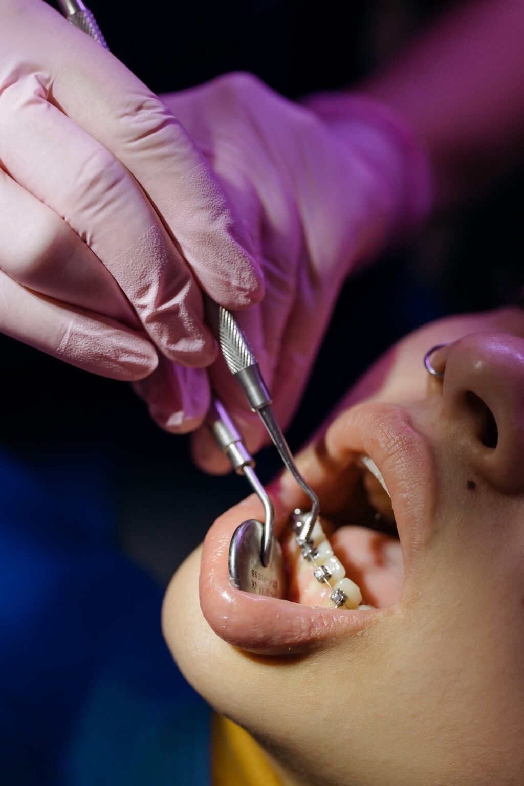Adult Braces: Exploring Orthodontic Treatments for Adults